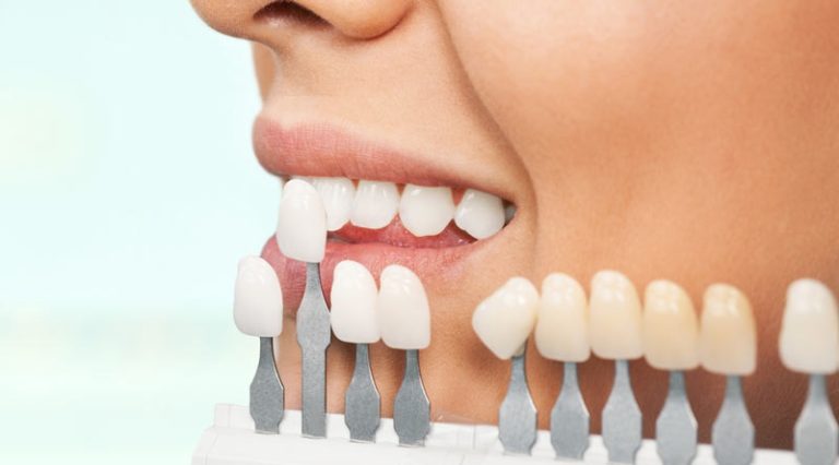 Direct vs. Indirect Restorations: What's the Difference?