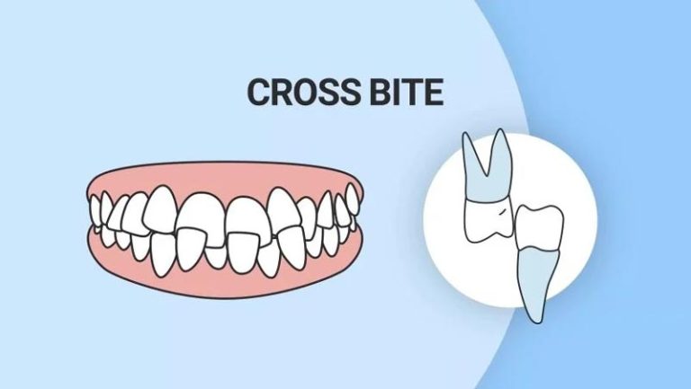 Crossbite in Kids: Causes and Treatment